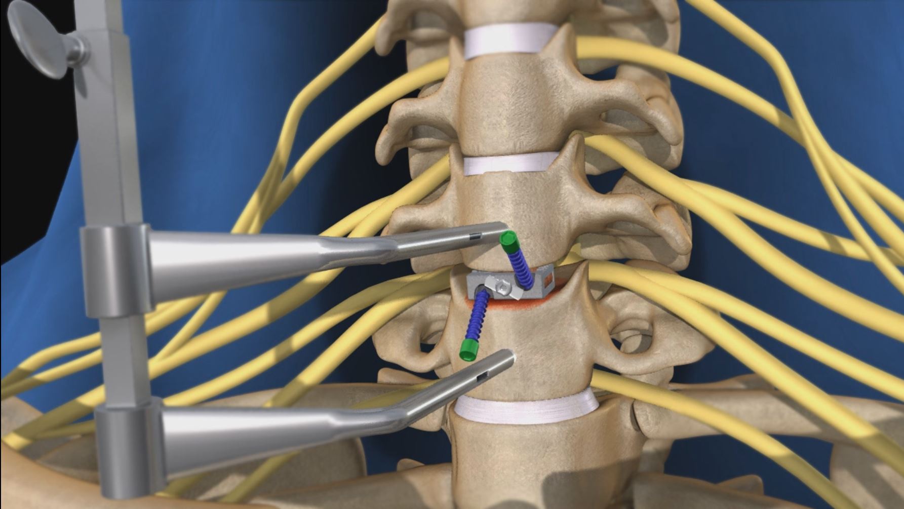 Trial Graphics - Powerpoint presentations, Animation, Medical Illustrations