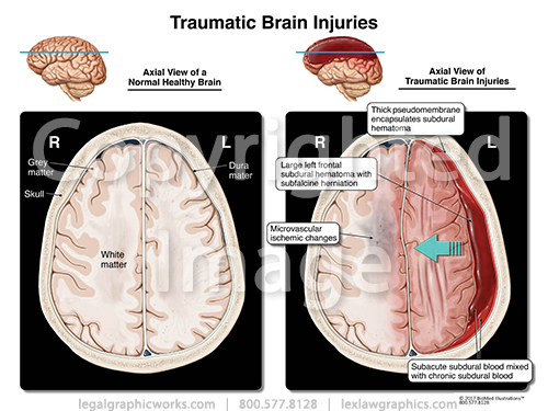 Traumatic Brain Injuries - Legal Graphicworks